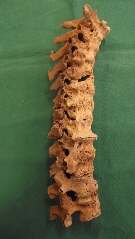 Spine Surgery Salem | Frequently Asked Questions